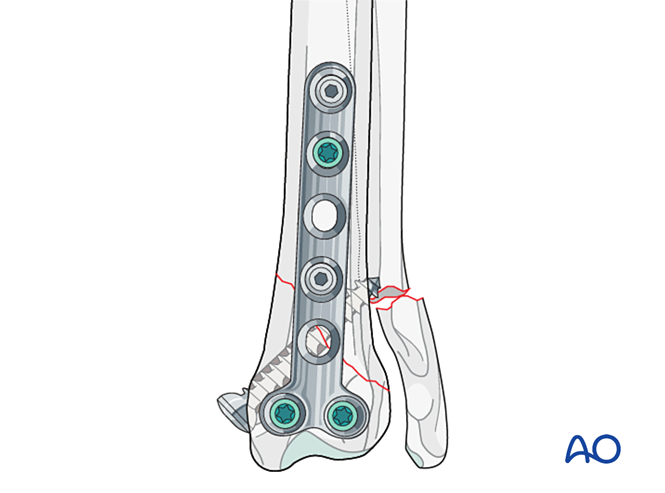 Lag screw and neutralization plate fixation for Simple extraarticular ...