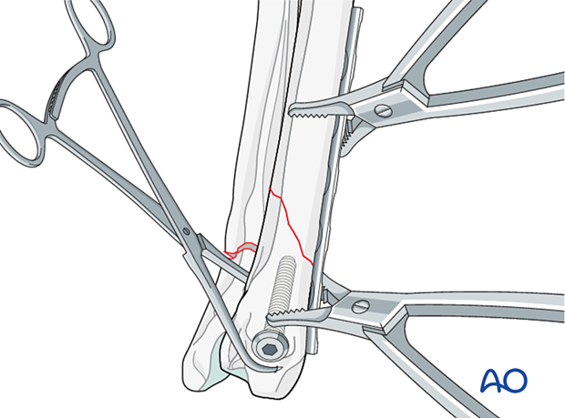 Lag screw and neutralization plate fixation for Simple extraarticular ...