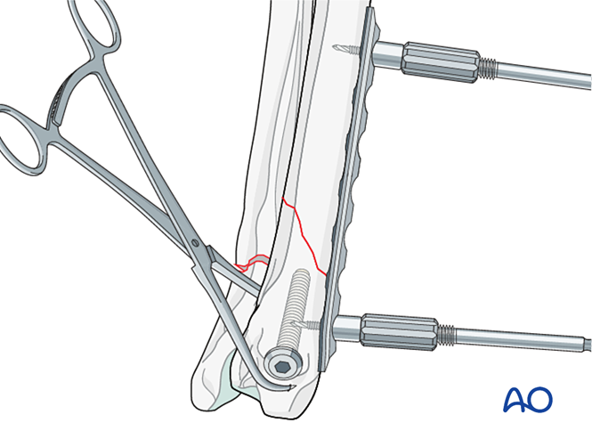 Lag screw and neutralization plate fixation for Simple extraarticular ...