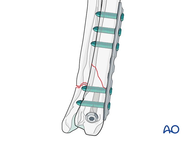 Lag screw and neutralization plate fixation for Simple extraarticular ...