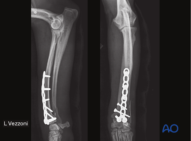 Lag screw and neutralization plate fixation for Simple extraarticular ...