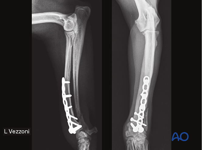 Lag screw and neutralization plate fixation for Simple extraarticular ...