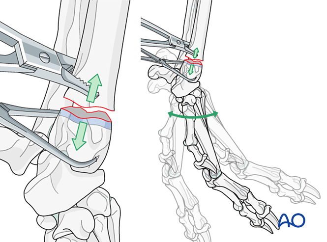 K-wire fixation for Simple extraarticular fracture of the distal radius