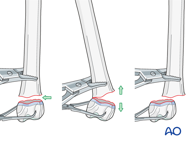 K-wire fixation for Simple extraarticular fracture of the distal radius