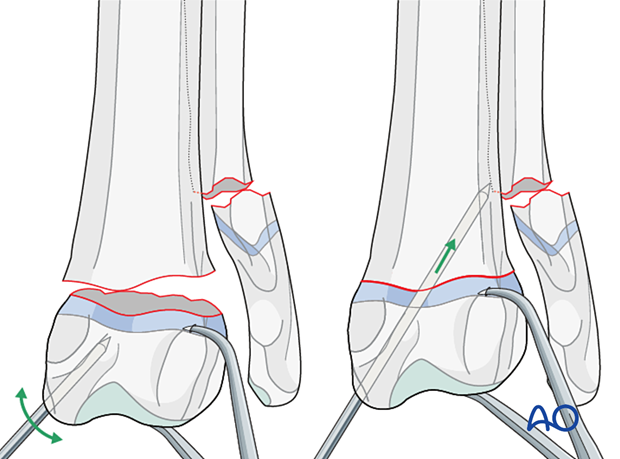 K-wire fixation for Simple extraarticular fracture of the distal radius