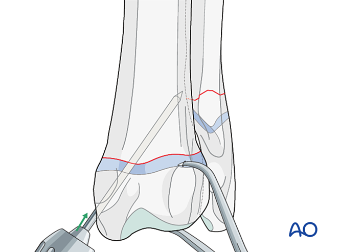 K-wire fixation for Simple extraarticular fracture of the distal radius