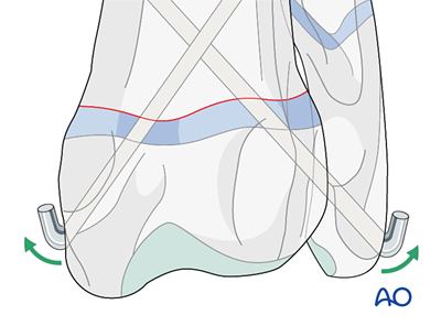 K-wire fixation for Simple extraarticular fracture of the distal radius