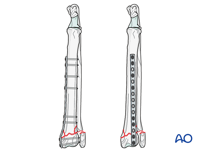 Bridging plate fixation for Multifragmentary extraarticular fracture of ...