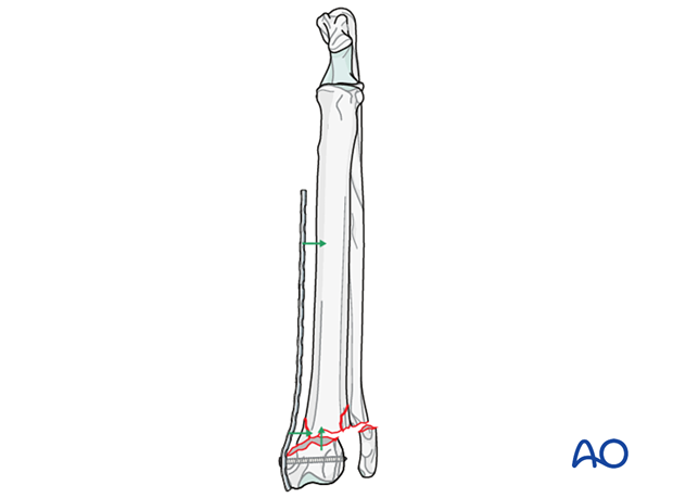 Bridging plate fixation for Multifragmentary extraarticular fracture of ...