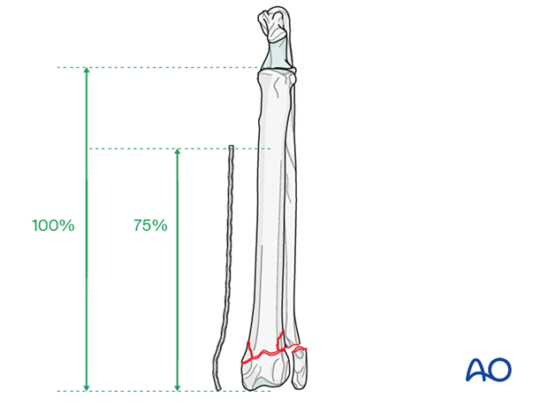 Bridging plate fixation for Multifragmentary extraarticular fracture of ...