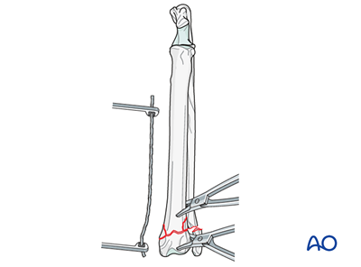 Bridging plate fixation for Multifragmentary extraarticular fracture of ...