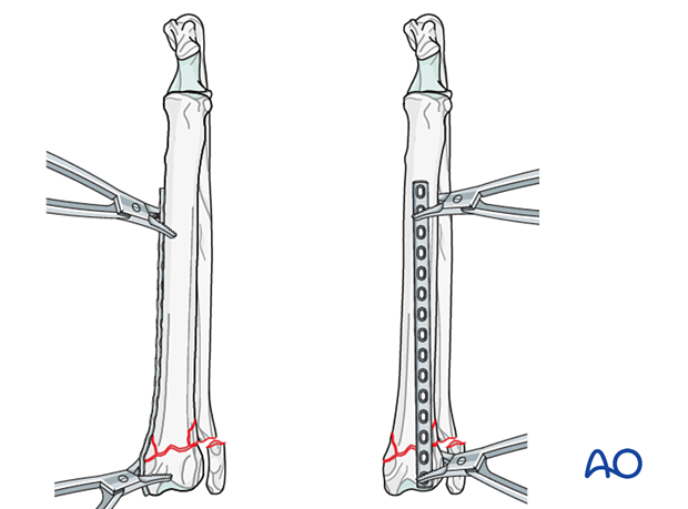 Bridging plate fixation for Multifragmentary extraarticular fracture of ...