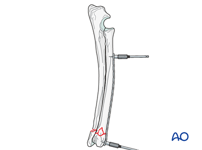 Bridging plate fixation for Multifragmentary extraarticular fracture of ...