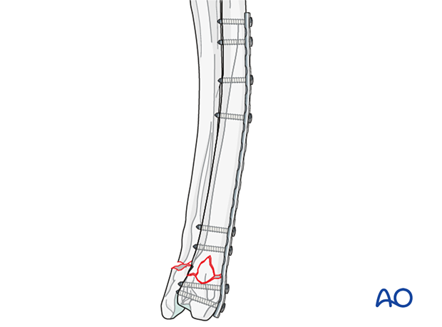 Bridging plate fixation for Multifragmentary extraarticular fracture of ...