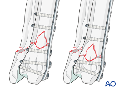 Bridging plate fixation for Multifragmentary extraarticular fracture of ...