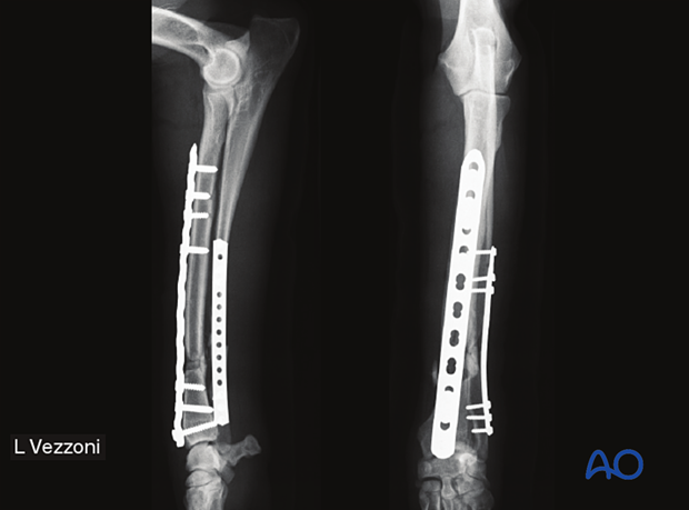 Bridging plate fixation for Multifragmentary extraarticular fracture of ...