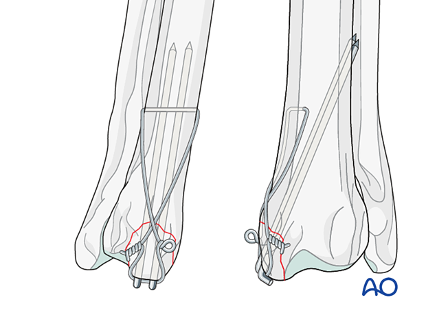 K-wire and tension band fixation for Partial articular sagittal ...