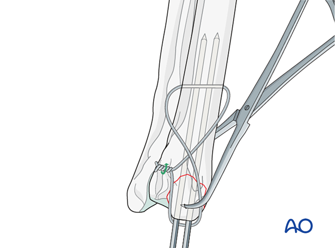K-wire and tension band fixation for Partial articular sagittal ...