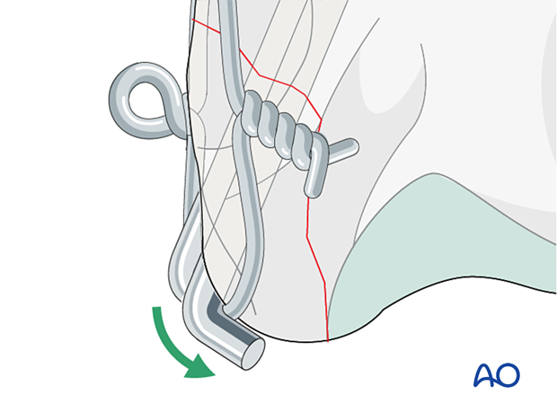 K-wire and tension band fixation for Partial articular sagittal ...