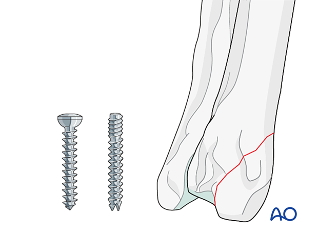 Lag screw fixation for Partial articular frontal fracture of the distal ...