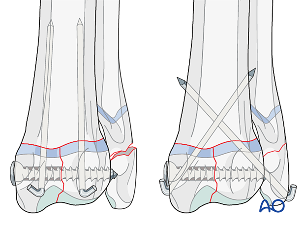 Lag screw and K-wire fixation for Simple complete articular fracture of ...
