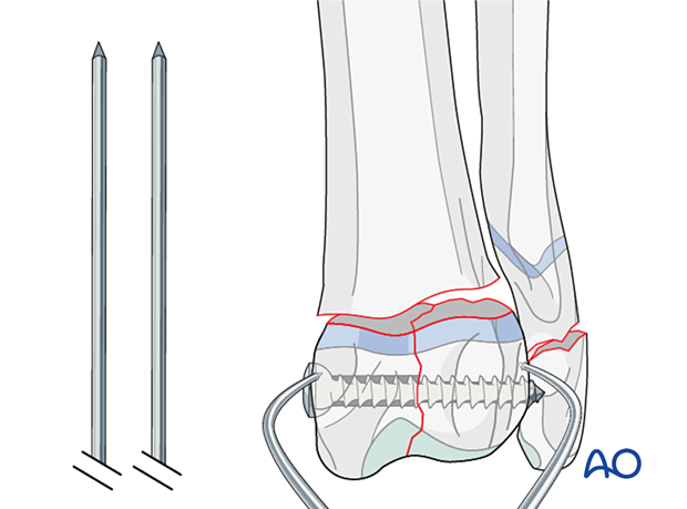 Lag screw and K-wire fixation for Simple complete articular fracture of ...