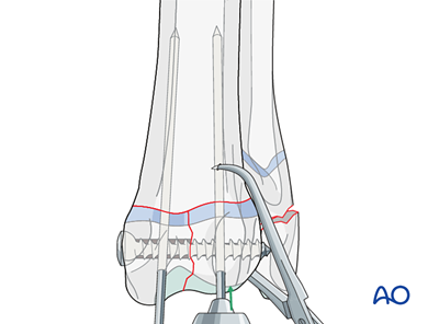 Lag screw and K-wire fixation for Simple complete articular fracture of ...