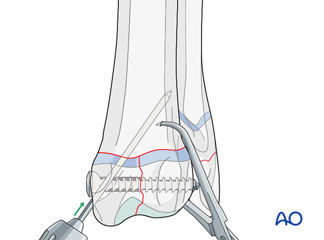 Lag screw and K-wire fixation for Simple complete articular fracture of ...