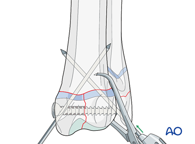 Lag screw and K-wire fixation for Simple complete articular fracture of ...