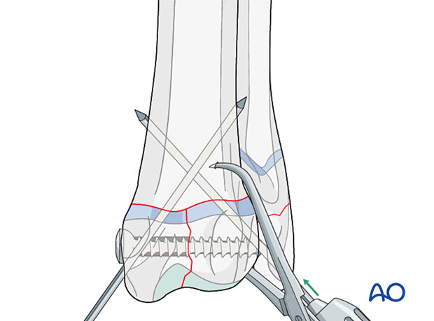 Lag screw and K-wire fixation for Simple complete articular fracture of ...