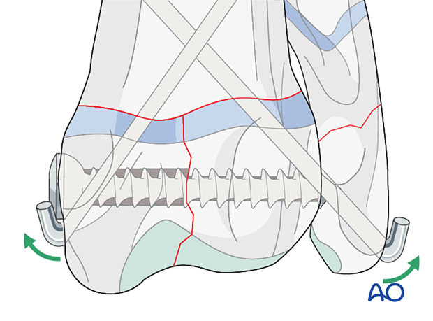 Lag screw and K-wire fixation for Simple complete articular fracture of ...