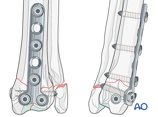 Lag screw and cranial plate fixation for Simple complete articular ...