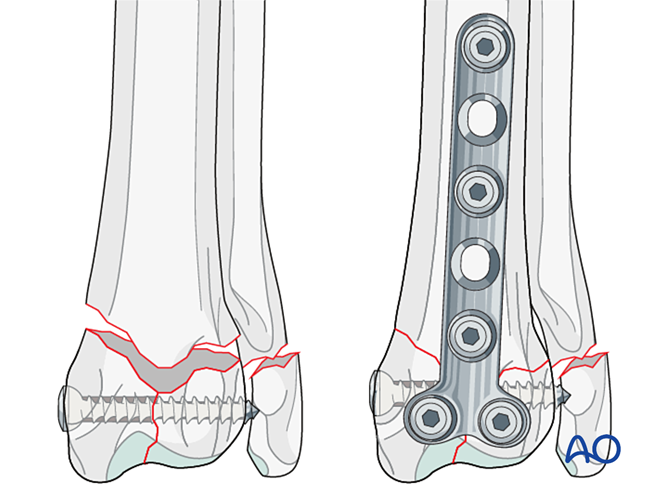 Lag screw and cranial plate fixation for Simple complete articular ...
