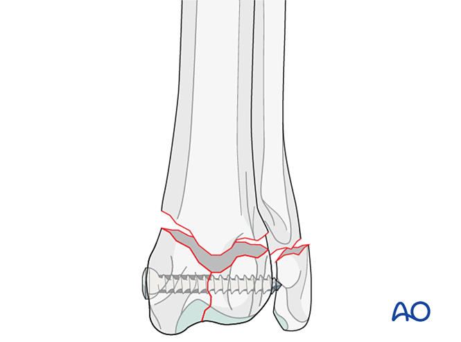 Lag screw and cranial plate fixation for Simple complete articular ...