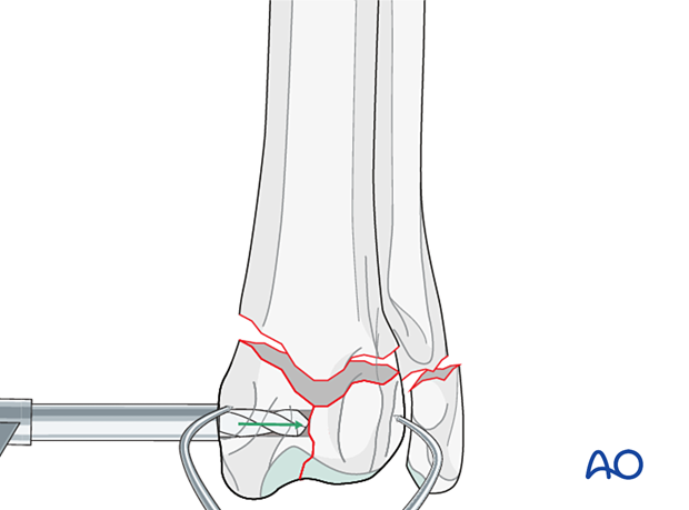 Lag screw and cranial plate fixation for Simple complete articular ...
