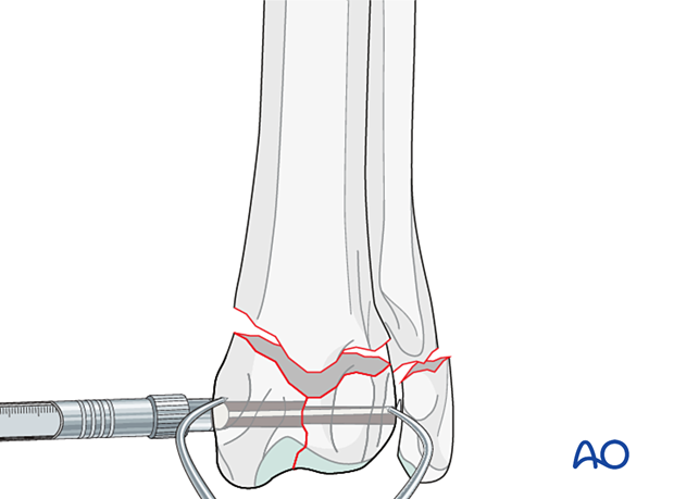 Lag screw and cranial plate fixation for Simple complete articular ...