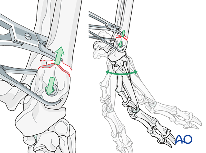Lag screw and cranial plate fixation for Simple complete articular ...