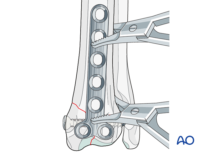 Lag screw and cranial plate fixation for Simple complete articular ...