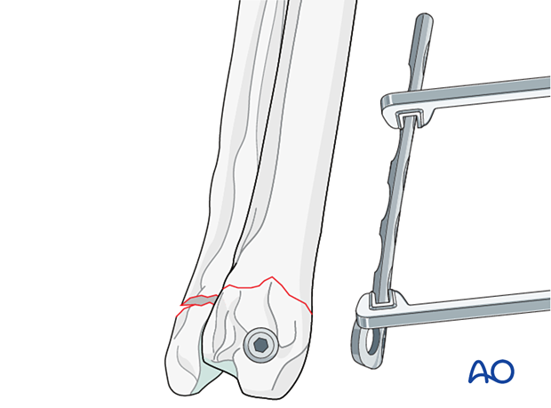 Lag screw and cranial plate fixation for Simple complete articular ...