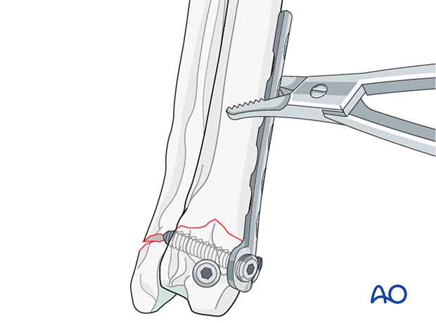 Lag screw and cranial plate fixation for Simple complete articular ...