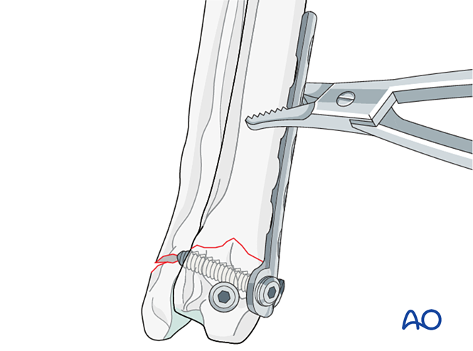 Lag screw and cranial plate fixation for Simple complete articular ...