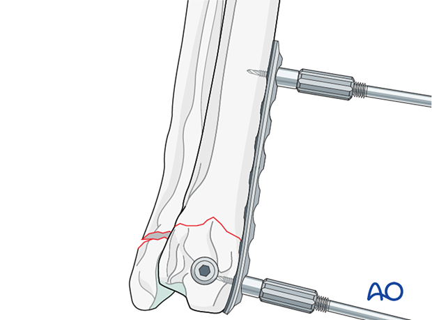 Lag screw and cranial plate fixation for Simple complete articular ...