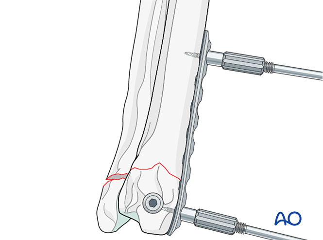 Lag screw and cranial plate fixation for Simple complete articular ...