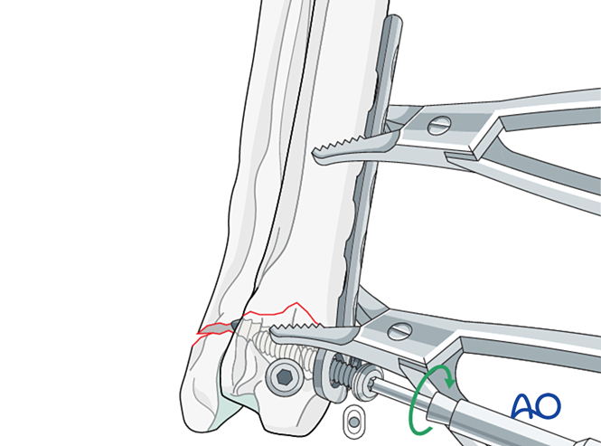 Lag screw and cranial plate fixation for Simple complete articular ...