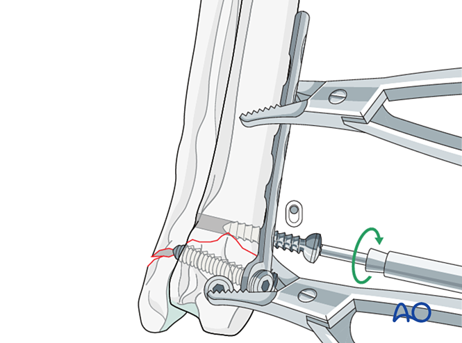 Lag screw and cranial plate fixation for Simple complete articular ...