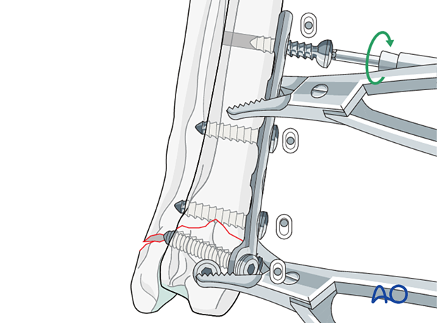 Lag screw and cranial plate fixation for Simple complete articular ...