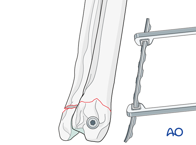 Lag screw and cranial plate fixation for Simple complete articular ...