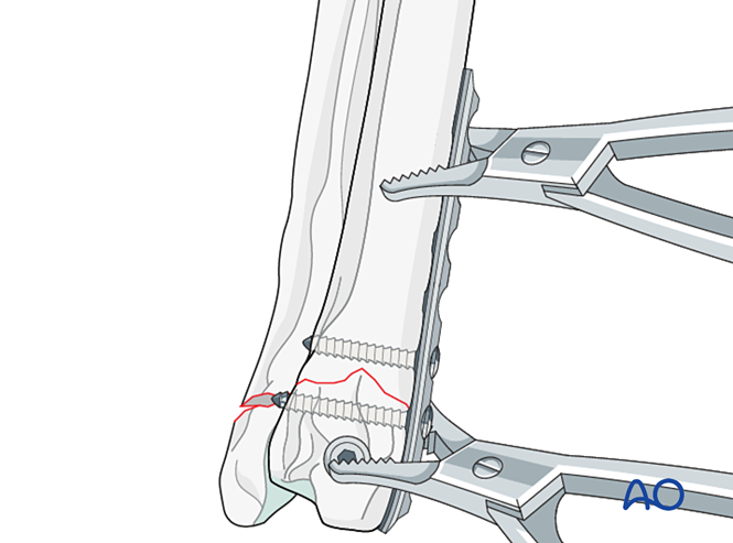 Lag screw and cranial plate fixation for Simple complete articular ...