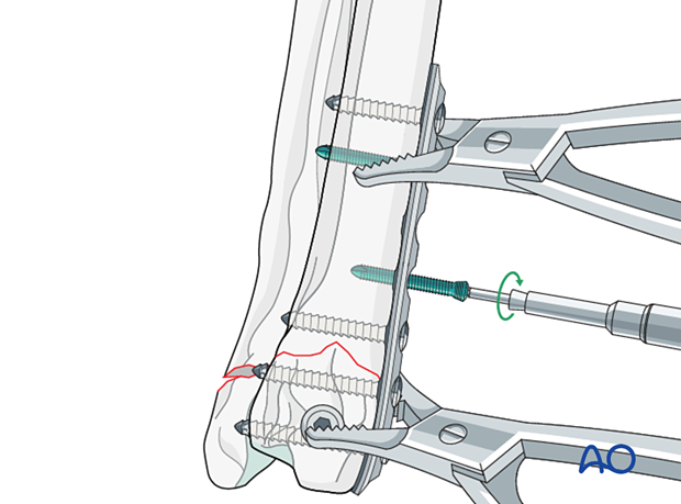 Lag screw and cranial plate fixation for Simple complete articular ...