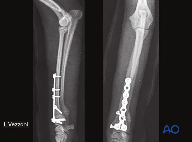 Lag screw and cranial plate fixation for Simple complete articular ...